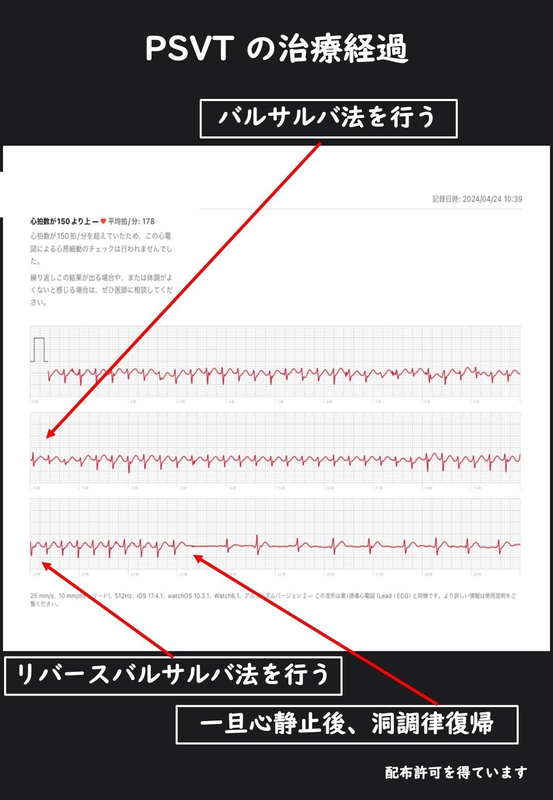PSVTのバルサルバ法｜オンライン看護学院