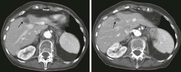 肝臓の溝(Accessory fissures/grooves)｜TKG画像診断