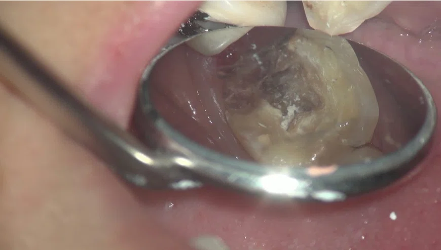 Case of Hemisection (Segmental Extraction)｜のだデンタルクリニック【杉並区の歯医者】