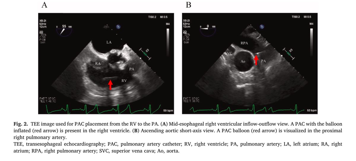 TTE補助下PAC挿入方法：Heliyon. 2024;10(19):e38643.｜muru