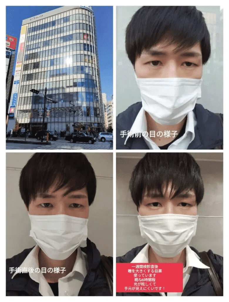 【新宿近視クリニック】ICL手術体験記 術後写真有 流れと評判口コミメリットデメリット クーポン 紹介 割引はあるの？｜Hiro＠フォロバ100