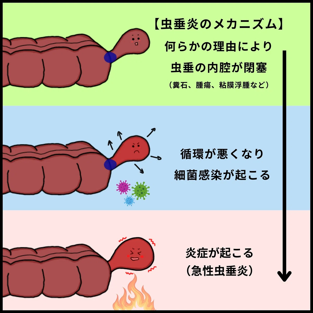 【虫垂炎（盲腸）になるとどうなる】 メカニズム・症状・特徴を分かりやすく解説 ｜おがちゃん先生／解剖生理