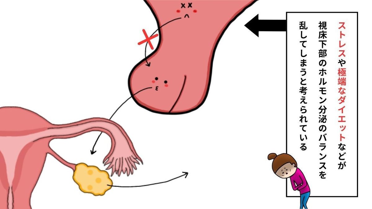 【無月経（生理がこない）の特徴】イラスト図解でわかりやすく解説!!｜おがちゃん先生／解剖生理
