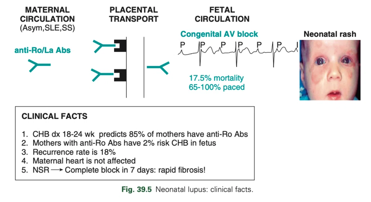 39 新生児ループス Neonatal Lupus Pathogenesis and Clinical Approaches｜Takizawa ...