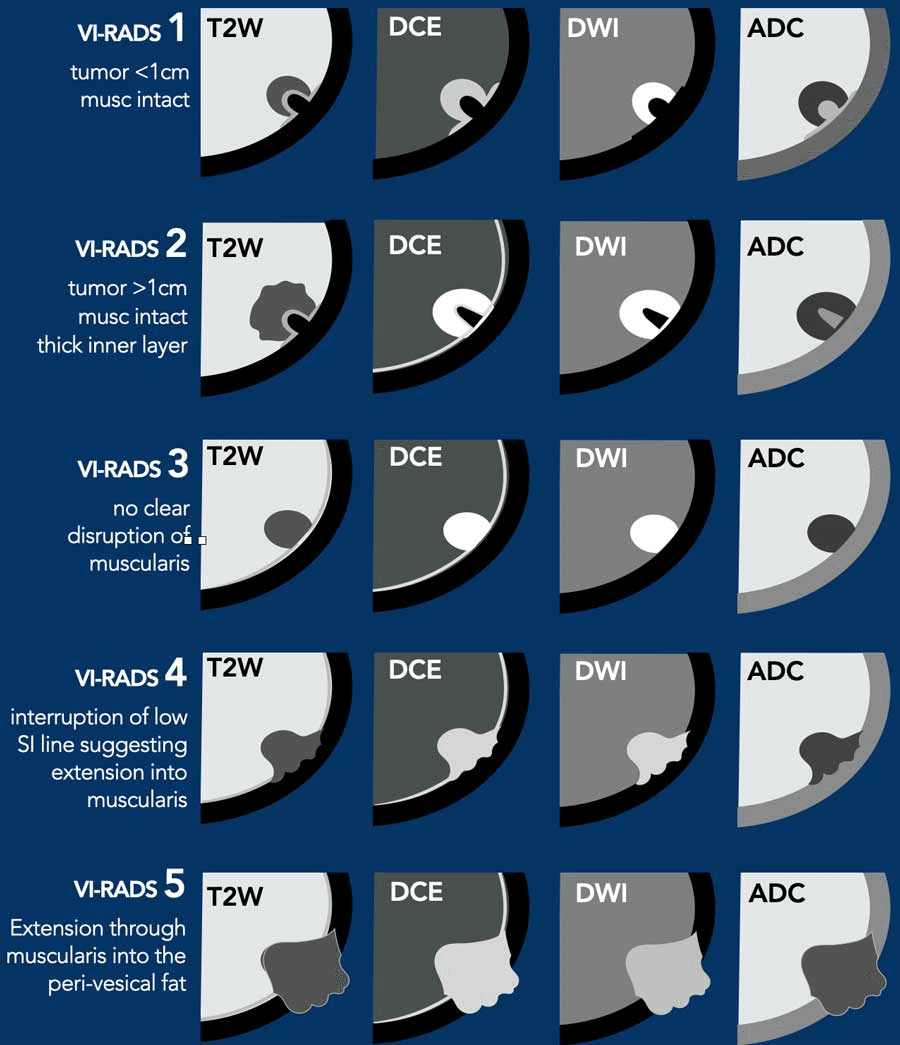 【VI-RADSまとめ】MRI膀胱癌筋層浸潤スコア｜TKG画像診断