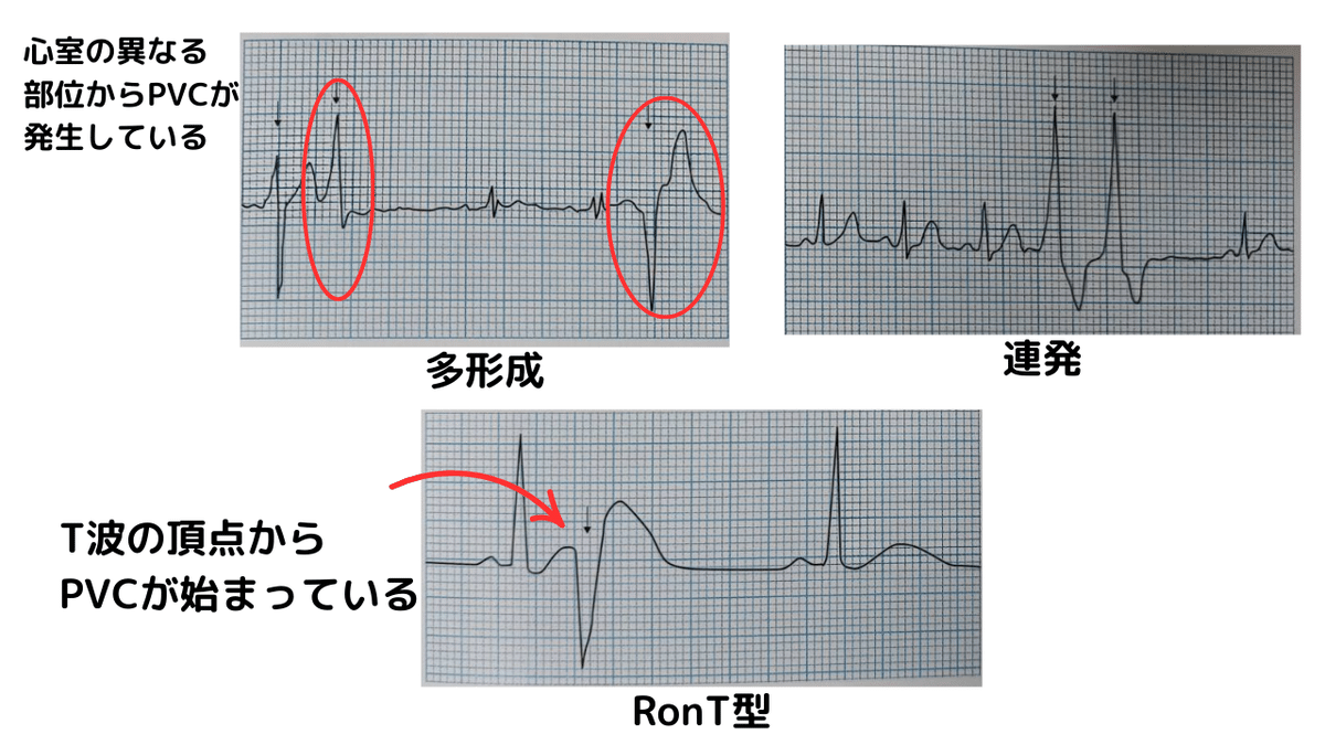 心室期外収縮（PVC）とは？原因・種類・心電図の特徴・対処法を徹底解説！｜ヒロの心電図ノート