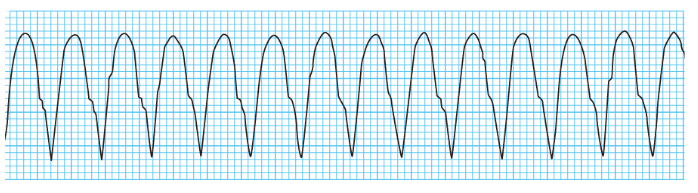 心停止の4つの波形とその対応！VF・VT・PEA・Asystoleを理解しよう｜ヒロの心電図ノート