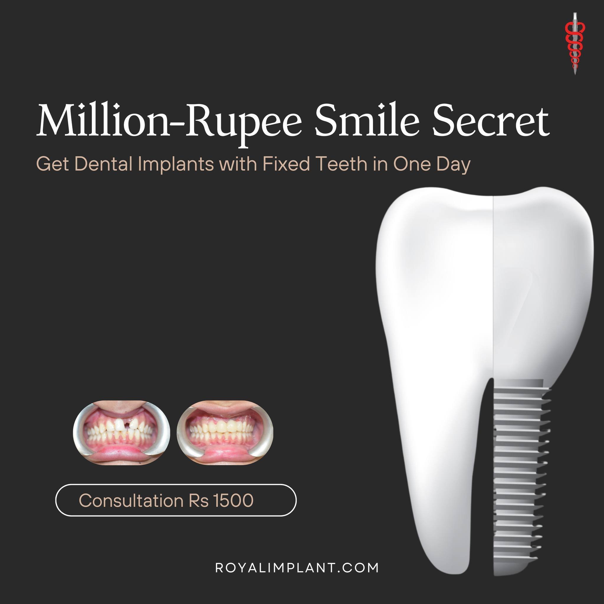 Get Fixed Teeth in a Day: Restore Your Smile with Dental Implants ...