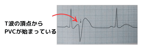 QT延長からTdP発生へ！RonTが引き金となる心電図の特徴とは？｜ヒロの心電図ノート
