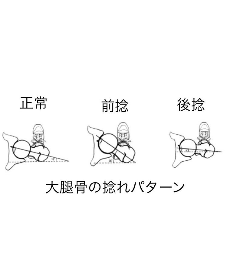 【骨形態学×大腿骨】股関節のねじれ角“前捻角”とは？〜歩き方や姿勢への影響を解説！〜｜PT yoshi