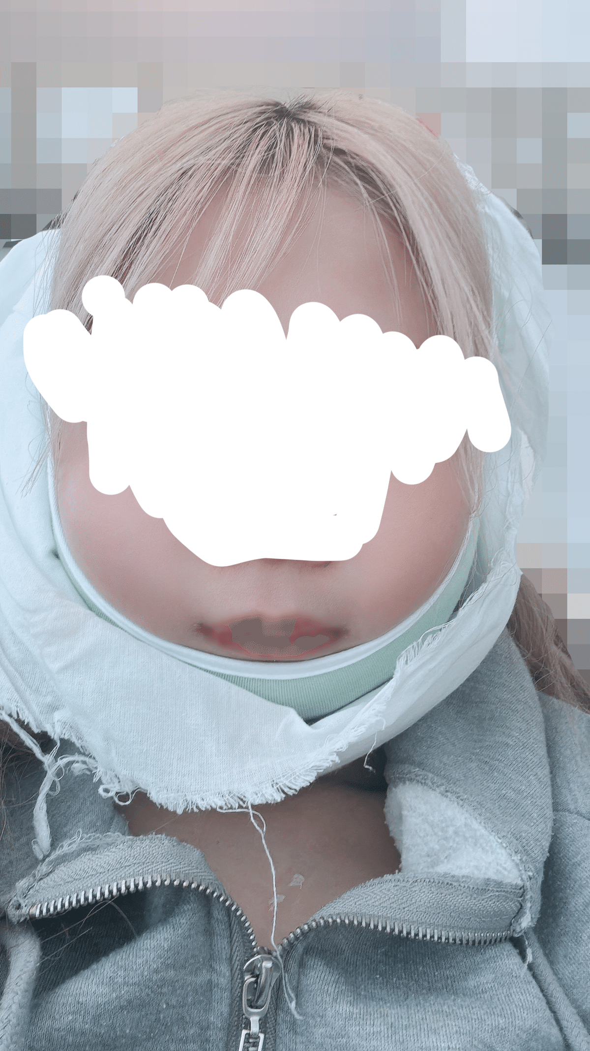 【咀嚼筋腱・腱膜過形成症】入院レポ3 5〜6日目｜gaw