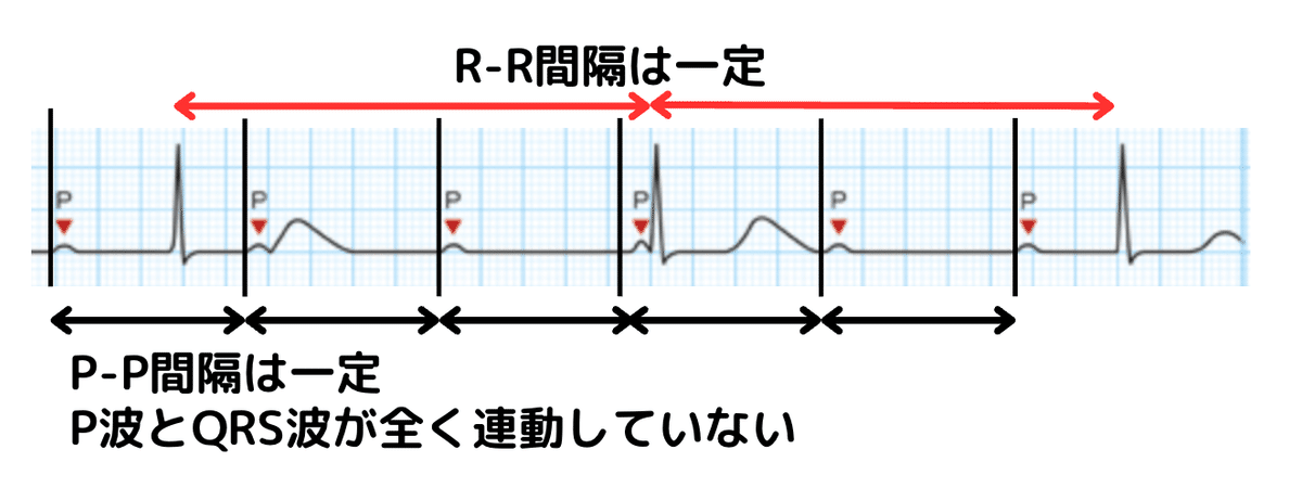 【心電図で学ぶ】房室ブロック（AVB）の分類とペースメーカー設定の基本｜ヒロの心電図ノート
