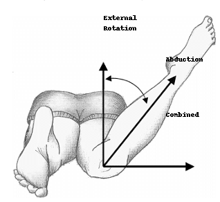 【骨形態×股関節痛】体重や筋力だけが痛みを引き起こすわけではない！〜股関節の痛みと”大腿骨のねじれ”の関係性とは～｜PT yoshi