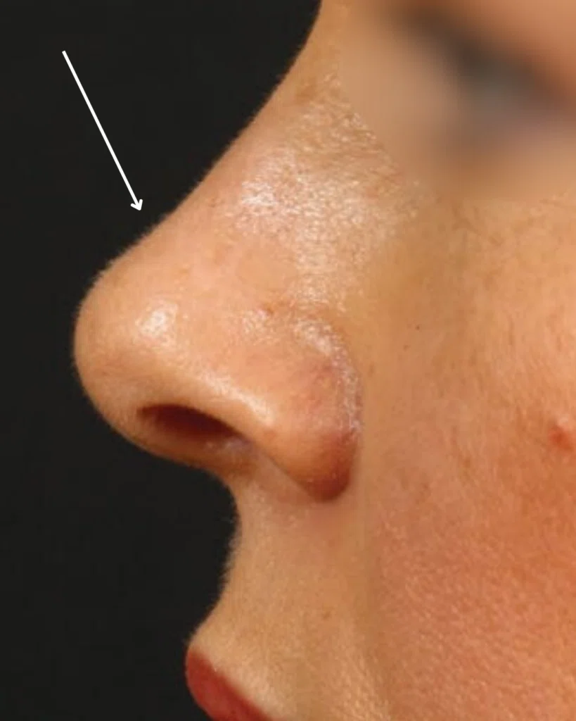 MSAの鼻形成のこだわり｜m_surgical_arts
