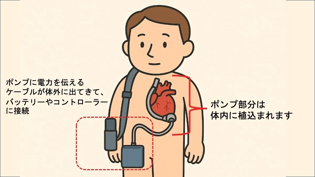 Mcs選択 末期心不全に使われる補助人工心臓（植込型vad）とは？ Heartmate 3の仕組みと適応を解説｜心臓外科 田所 直樹 M 1830