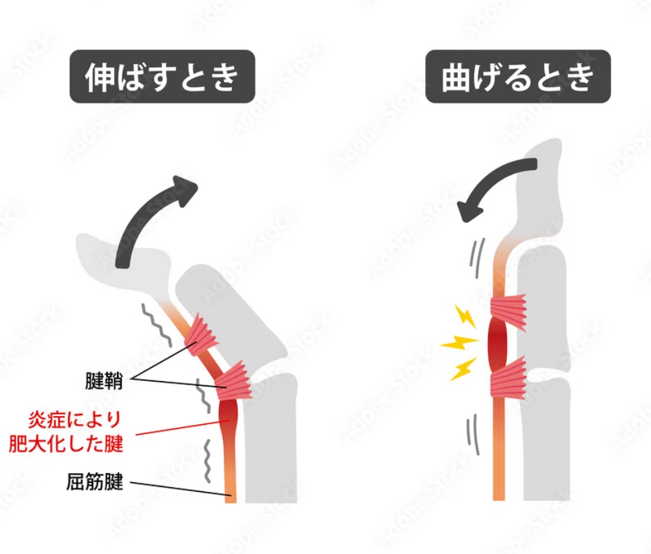 My finger won't straighten when I wake up!? ~No surgery needed! Self ...