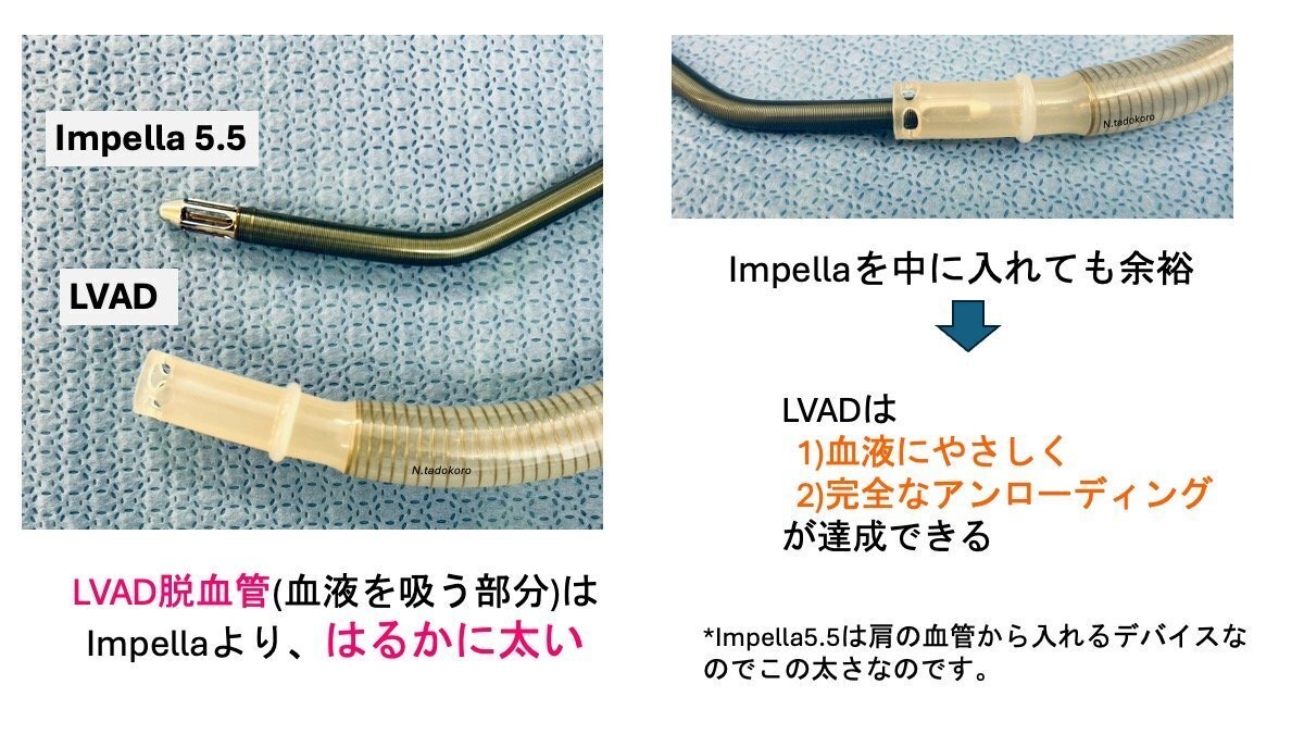 Impella（インペラ）は最適な補助循環装置なのか？ ーImpellaと体外式補助人工心臓（VAD）との違いと移行のタイミング｜心臓外科 ...