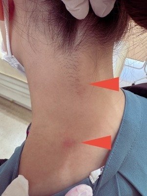 線状皮膚炎(dermatitis linearis)｜みずけん