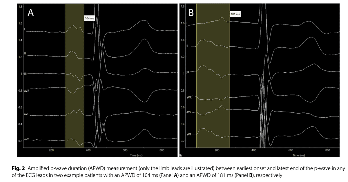 COPD心房細動リスク：atrial cardiomyopathy (AtCM)：増幅P波持続時間 (APWD) 131mSec以上｜Makisey