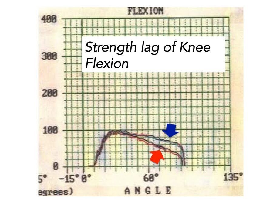 早期トレーニングの是非：ACL再建術後のハムストリング管理の最前線｜Brain storm conditioning 〜 脳からコンディショニング