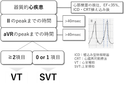 心室頻拍（Ventricular Tachycardia：VT）｜心電’s 合格塾（藤澤友輝）