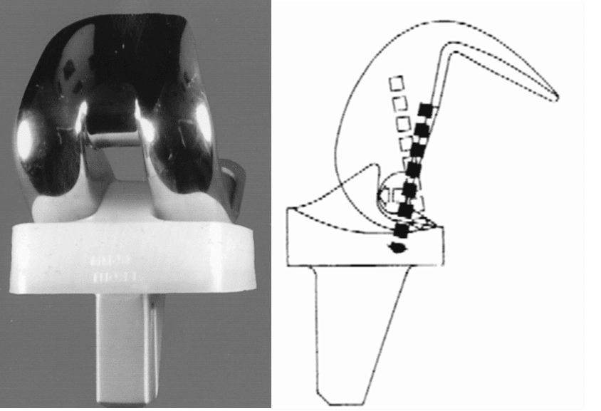 【第60回】EBMを超えて考えるTKA機種選択③ Posterior Stabilized (PS)型｜TKAdoc