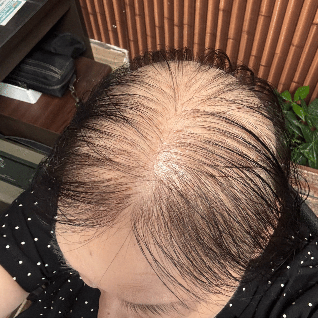 【子宮体がん】抗がん剤（TC療法）2クール目｜yumi