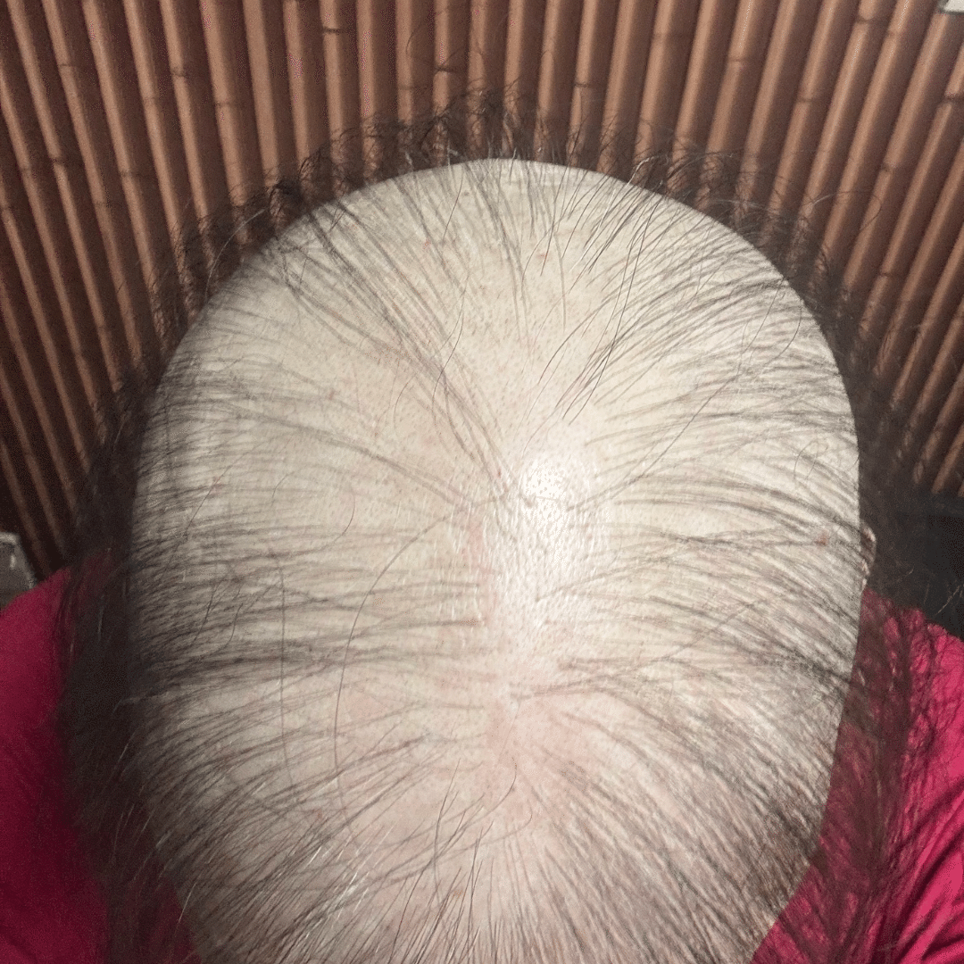 【子宮体がん】抗がん剤（TC療法）3クール目｜yumi