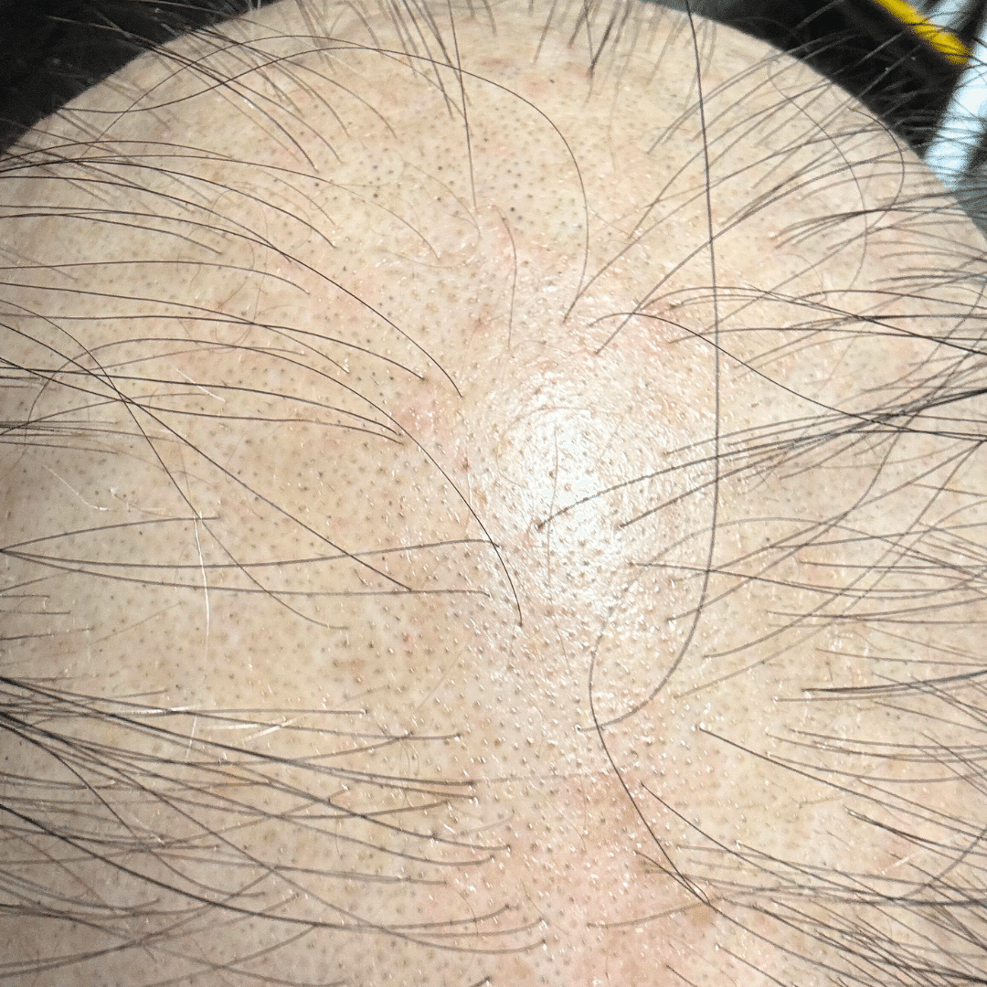 【子宮体がん】抗がん剤（TC療法）4クール目｜yumi