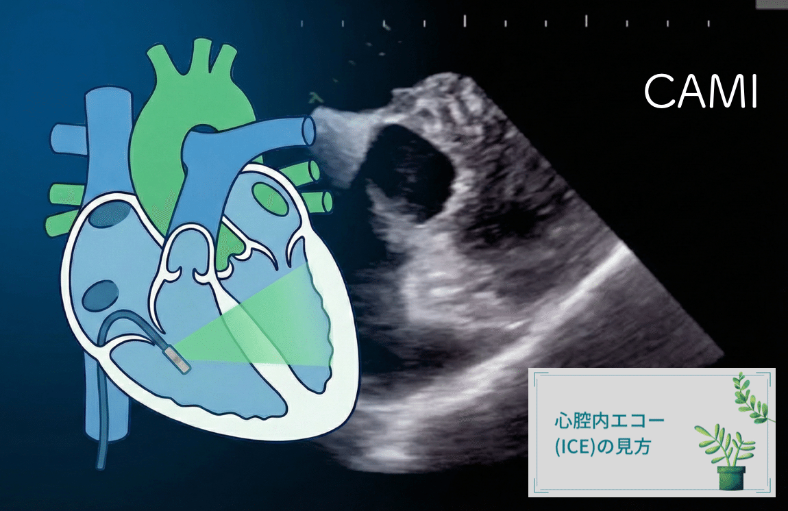 【動画解説】心腔内エコー（ICE）操作の基本とコツ 〜SOUNDSTARとCARTO3の連携〜 心房編｜Comprehensive ...