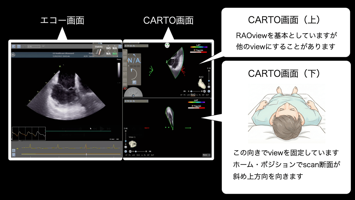 【動画解説】心腔内エコー（ICE）操作の基本とコツ 〜SOUNDSTARとCARTO3の連携〜 心房編｜Comprehensive ...
