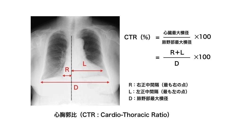 [Explained by a Cardiologist] What if you are told your heart is ...