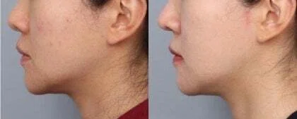 表情魔女顎（dynamic chin ptosis）とは？｜一致整形外科 ムン・ヒョンソク
