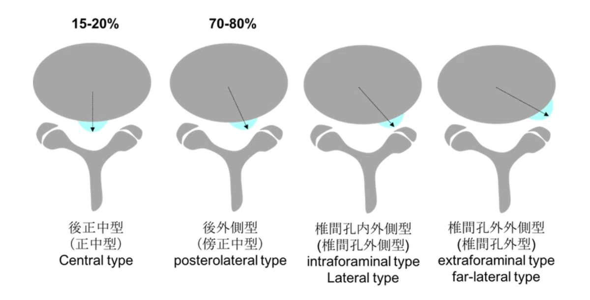 What is the relationship between lumbar disc herniation and compressed ...