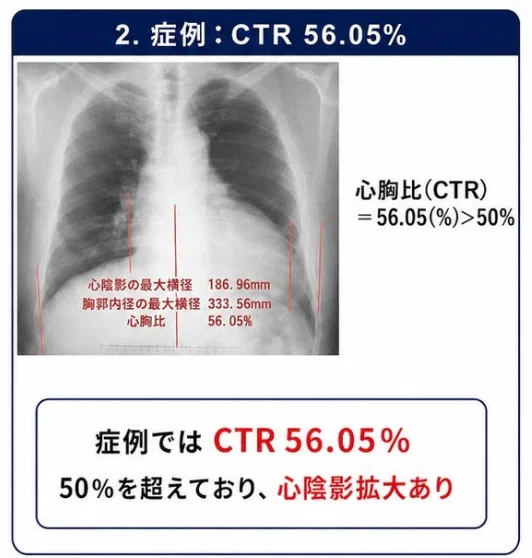 [Chest X-ray] What is cardiomegaly? Understanding the Cardiothoracic ...