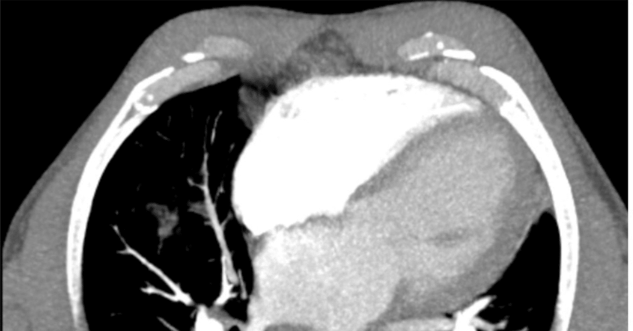 蛋白同化ステロイド乱用による心筋症｜TKG画像診断｜note