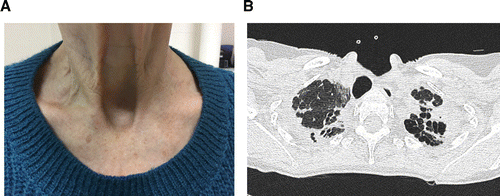 PPFEでは胸骨上切痕が深くなる｜TKG画像診断