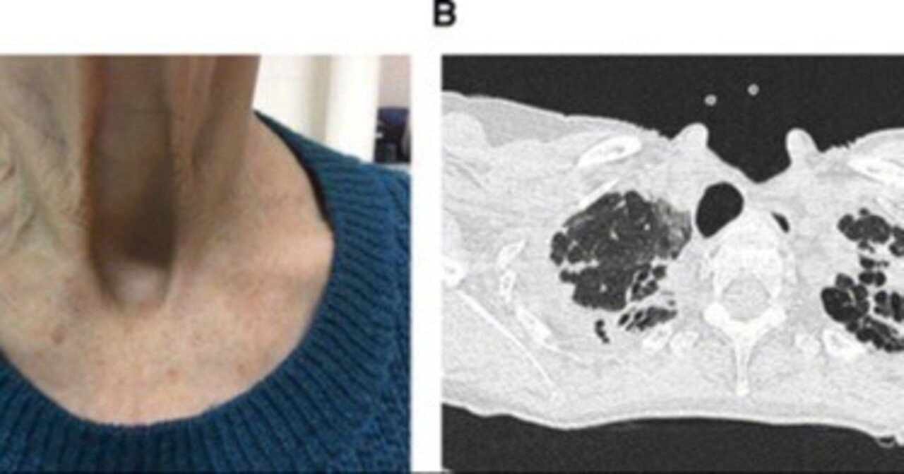 PPFEでは胸骨上切痕が深くなる｜TKG画像診断