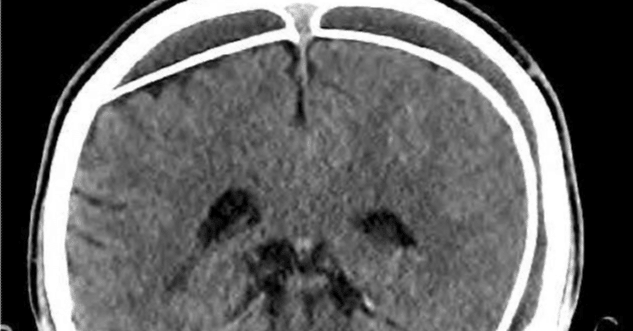 Calcified chronic subdural hematoma(石灰化慢性硬膜下血腫)｜TKG画像診断