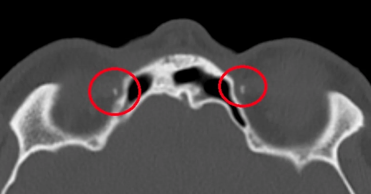 Calcified trochlear apparatus｜TKG画像診断