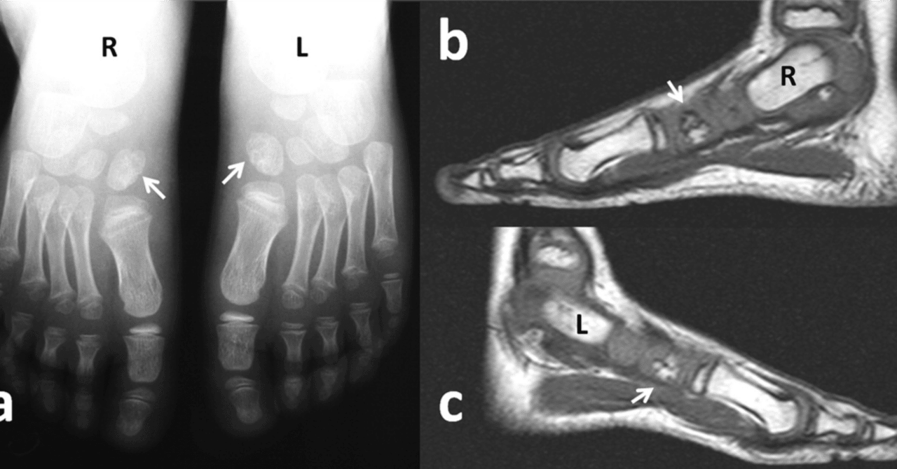 Osteochondrosis of the Medial Cuneiform Bone｜TKG画像診断