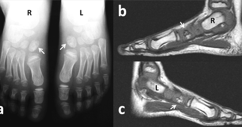 Osteochondrosis of the Medial Cuneiform Bone｜TKG画像診断