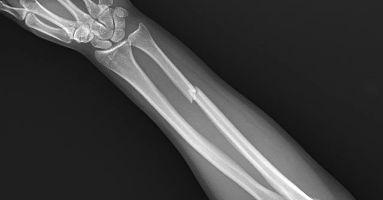 Nightstick fracture(警棒骨折)｜TKG画像診断