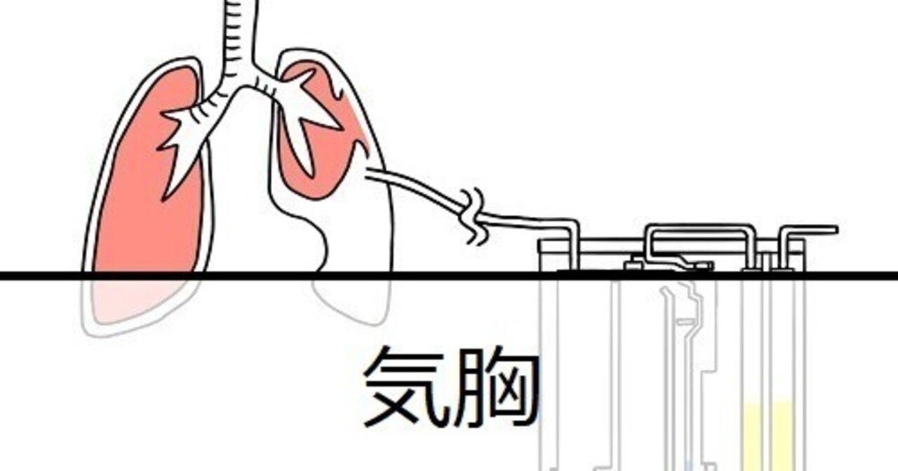 【完全公開はnoteだけ】サクッとまるわかり！気胸の看護診断｜なんでなんだナーシング20 ～看護師・看護学生のための超まとめサイト～