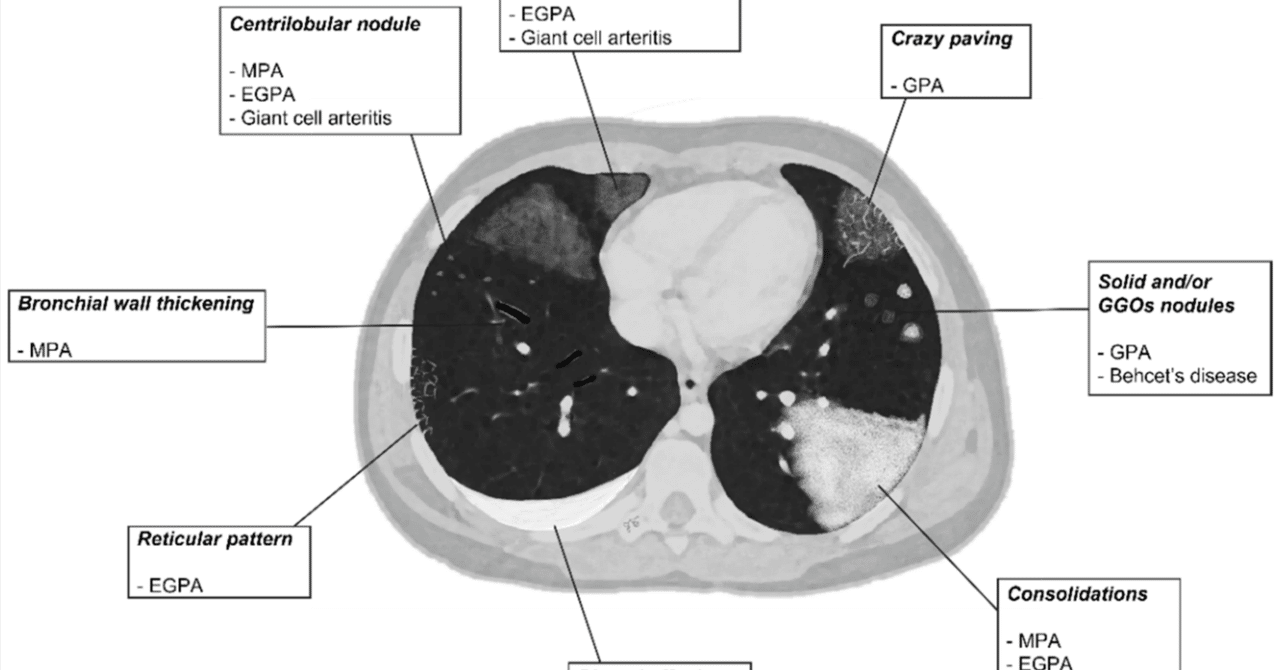 肺血管炎のCT所見パターン｜TKG画像診断