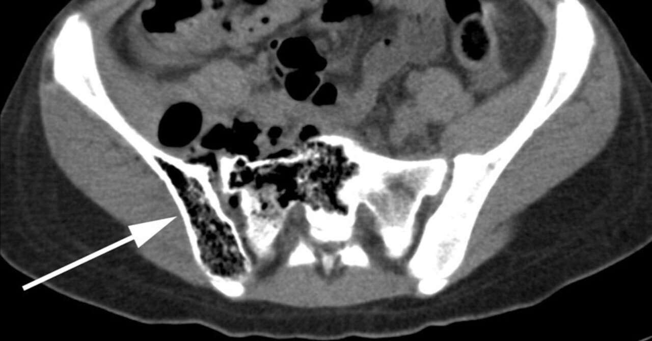 Emphysematous osteomyelitis(気腫性骨髄炎)｜TKG画像診断