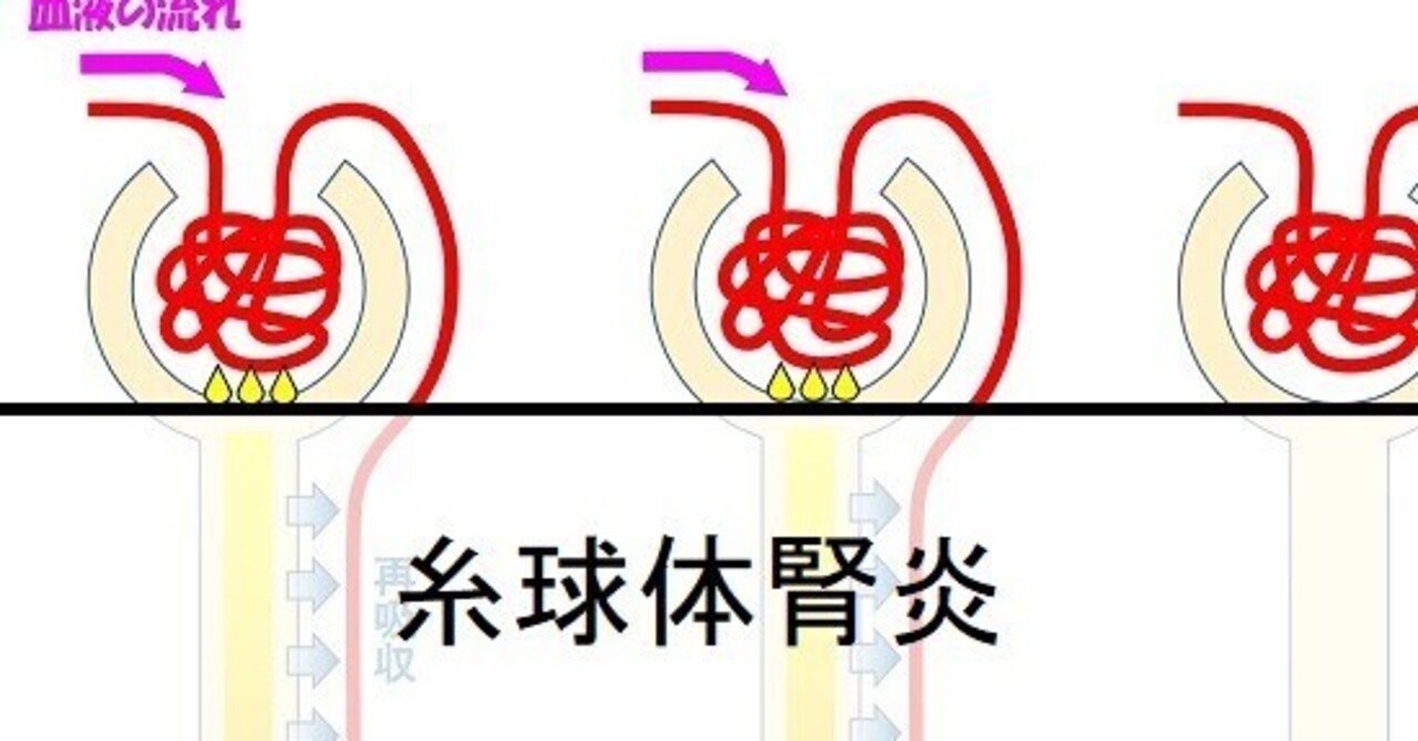 【完全公開はnoteだけ】サクッとまるわかり！糸球体腎炎の看護診断｜なんでなんだナーシング30