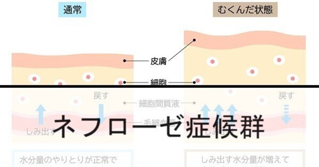 【完全公開はnoteだけ】サクッとまるわかり！ネフローゼ症候群の看護診断｜なんでなんだナーシング30