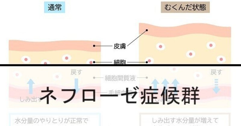 【完全公開はnoteだけ】サクッとまるわかり！ネフローゼ症候群の看護診断｜なんでなんだナーシング30 ～看護師・看護学生のための超まとめサイト～