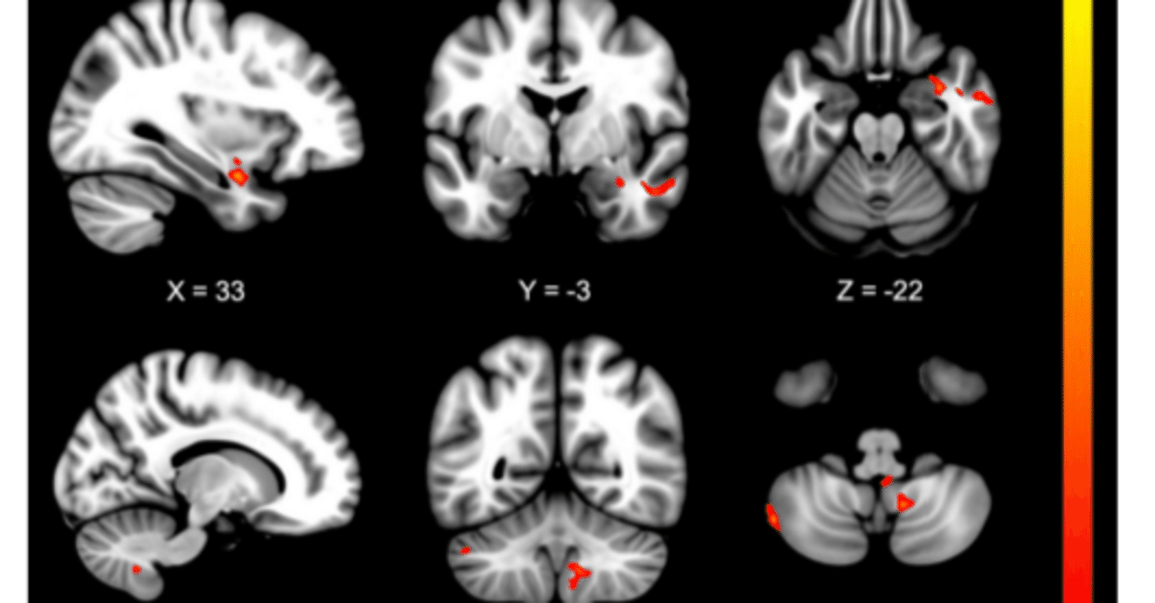 高齢者の認知症リハビリが膝ACL再建術後のアスリートを救う！｜Brain storm conditioning 〜 脳からコンディショニング